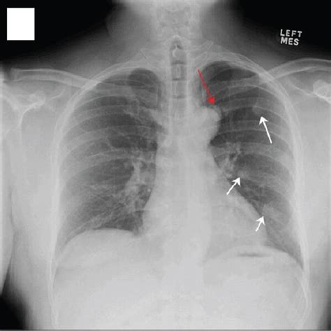 chest x ray a anteroposterior view showing a 1 7x1 4 cm nodular