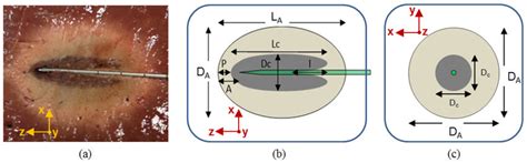 Schematic Representation Of The Zone Of Ablation And Appearance Of The Download Scientific
