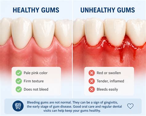 Are Bleeding Gums Normal Gum Disease