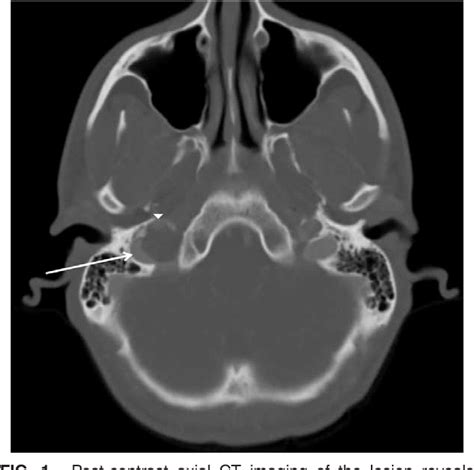 Figure 1 From Temporal Bone Histopathology Case Of The Month Malignant Peripheral Nerve Sheath