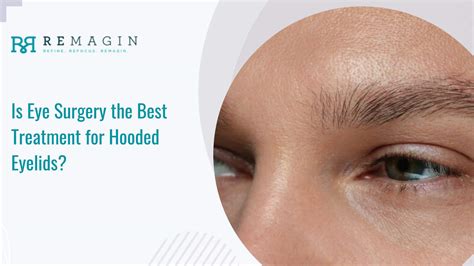 Exploring Tear Duct Surgery: When and Why It’s Necessary