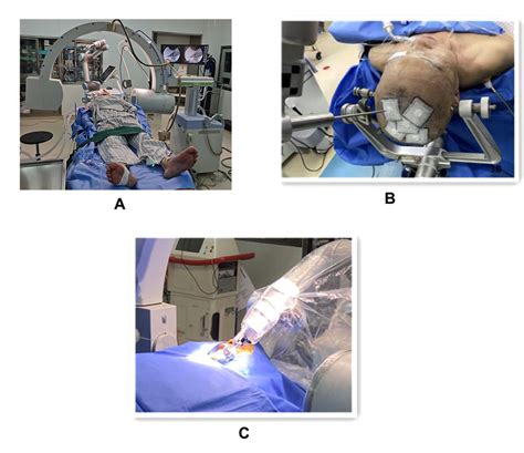 The Procedure Of Robot Assisted Percutaneous Balloon Compression A
