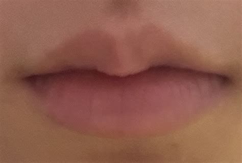 시술수술 질문 입술필러를 하는게 강남언니 1등 성형수술and피부시술 정보앱