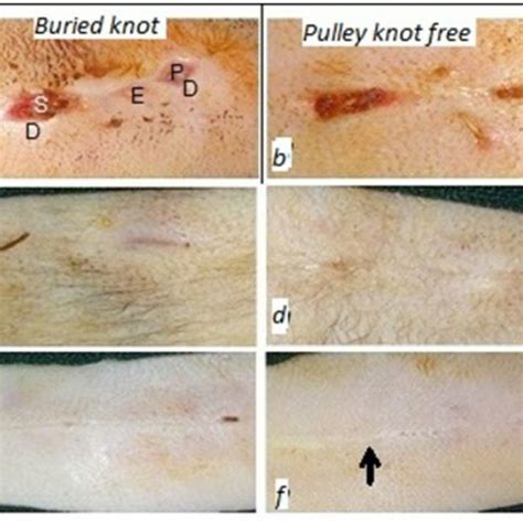 Two Methods Of Anchoring The Continuous Intradermal Suture Pattern