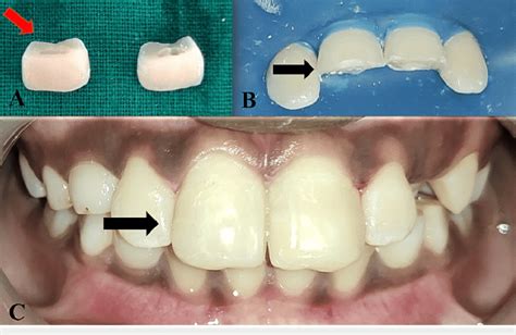 Fragment Re Attachment With 11 And 21 A Broken Teeth Fragments B Download Scientific Diagram