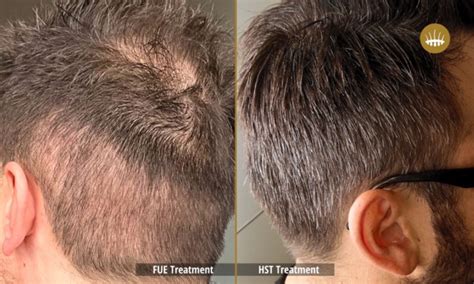 Hst Vs Fue Advantages And Benefits Hair Science Indonesia