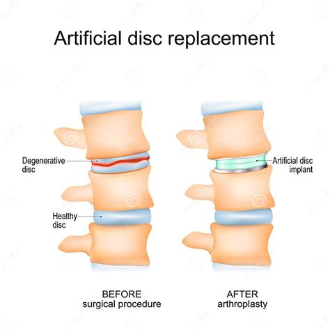 Intervertebral Disc Arthroplasty Stock Vector Illustration Of Human