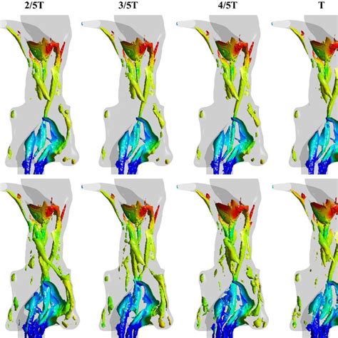 Comparison Of Airway Vortex Structures Within A Uvula Flapping Period