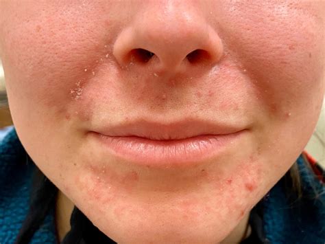 Dermatitis Around My Mouth At Alana Tebbutt Blog