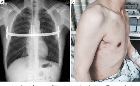 Rib Fracture Flail At Marsha Shain Blog