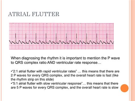 Atrial Flutter Atrial Fibrillation Guglview