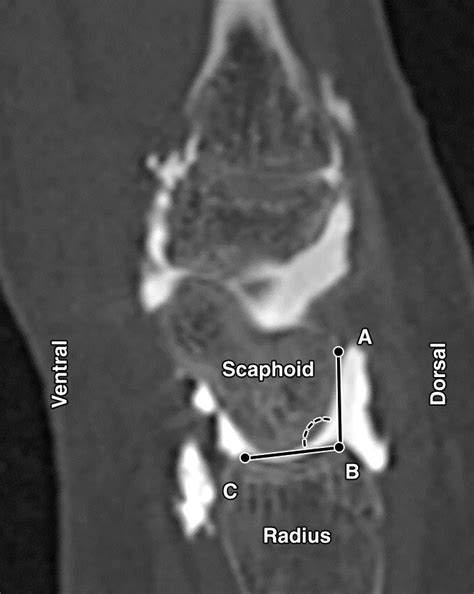 Posterior Radioscaphoid Angle As A Predictor Of Wrist Degenerative Joint Disease In Patients