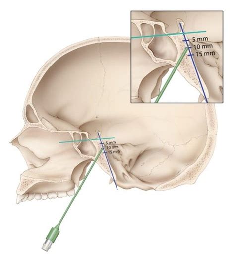 The Neurosurgical Atlas On Linkedin When Performing Percutaneous Rhizotomy For Trigeminal