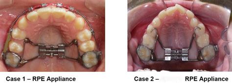 Sleep Apnea Pickard Orthodontics Pullman Wa Moscow Lewiston Id