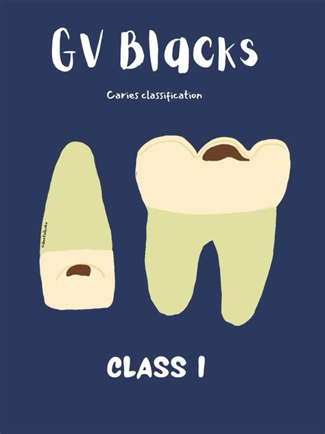 Class 1 Caries Sensitive Teeth Dental Caries Dental