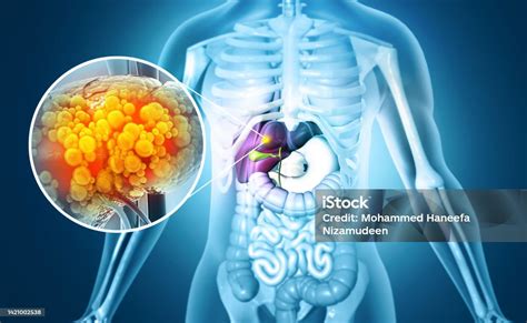 지방간 섬유증 간경변 및 간암과 같은 간 손상 3d 일러스트레이션 간암에 대한 스톡 사진 및 기타 이미지 간암 경화증 간 내부 기관 Istock