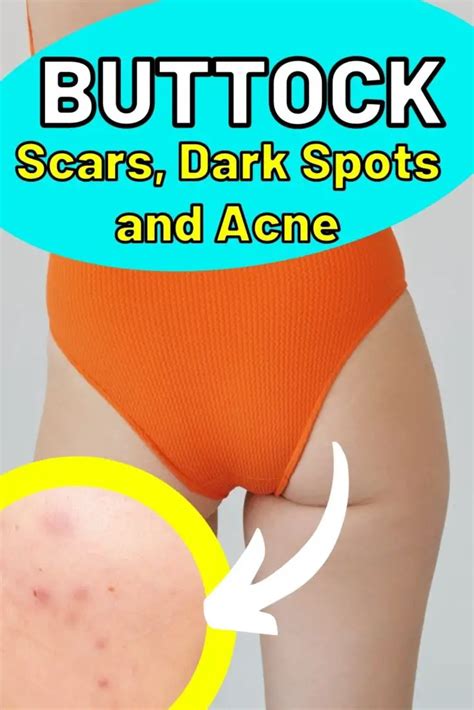 How To Get Rid Of Buttock Scars Dark Spots And Acne Naturally