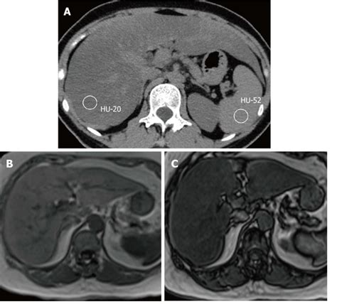 Diffuse Hepatic Steatosis Is Demonstrated Here In The Non Enhanced Download Scientific Diagram