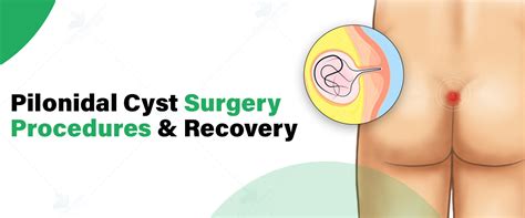 Pilonidal Cyst Surgery Procedures And Recovery