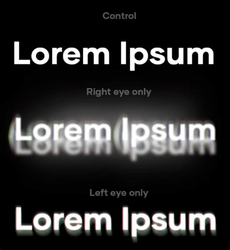 Is This Possibly Keratoconus R Keratoconus