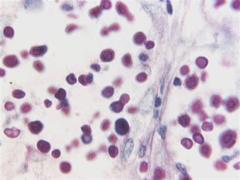 Americans With Aids Should Be Screened For Cryptococcus