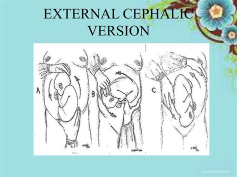 External Cephalic Version Obg Notes Pptx
