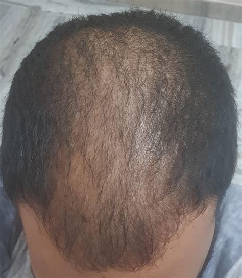 M24 Indian Facing Mpb Problem Since 2yrsany Suggestions Will I Be