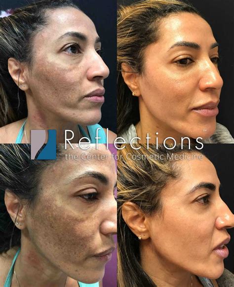 Melasma Laser Treatment Results For Hispanic Female Before And After