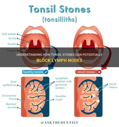 Understanding How Tonsil Stones Can Potentially Block Lymph Nodes Medshun