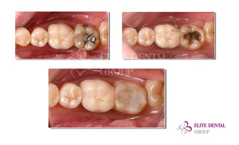 What Is A Tooth Filling Everything You Need To Know