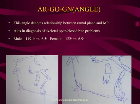 Cogs Analysis Cephelometrics For Orthognathic Surgery Fixed