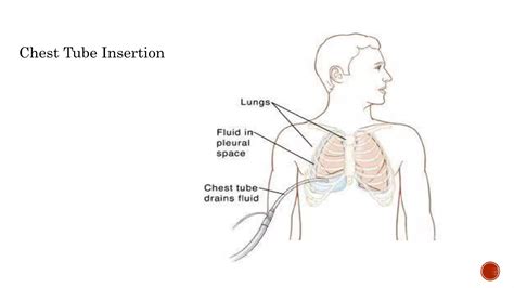 Chest Trauma Pptx