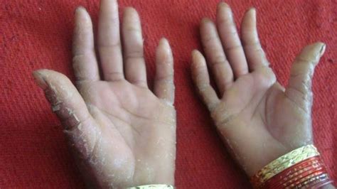 A Keratoderma Over Bilateral Hands Download Scientific Diagram