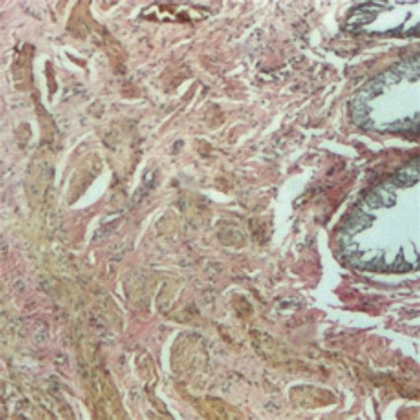 Extrarenal Pelvis Download Scientific Diagram