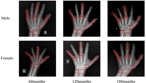 Radiology Bone Age At Vicki Howes Blog