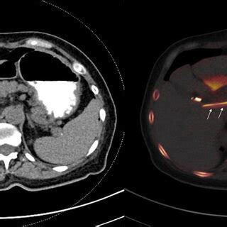 A Left Axial Slice Of A Dual Energy CT Abdomen Pelvis Without IV Download Scientific