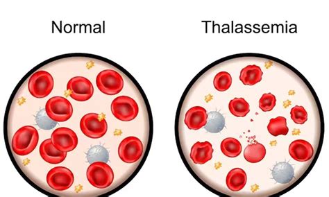 Thalassemia Inovasi Terbaru Pengelolaan Penyakit Darah