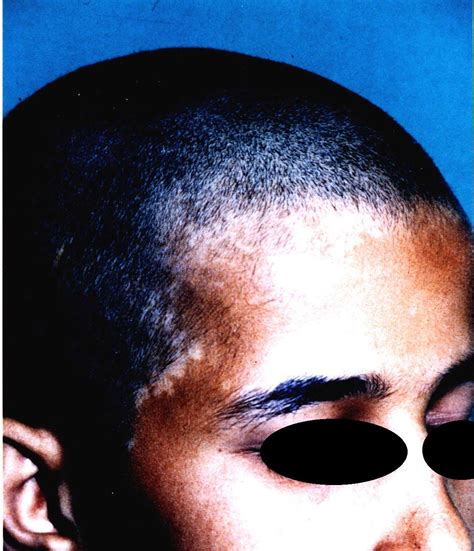 Pityriasis Versicolor