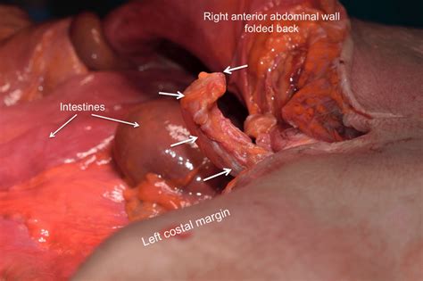 Superolateral View Of The Xiphoid Process Identified During Routine Download Scientific Diagram