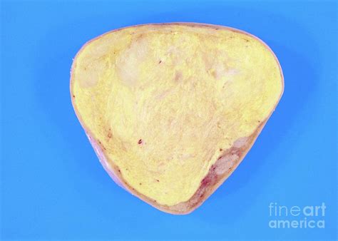 Cut Specimen Of Thecoma Theca Cell Tumour By Science Photo Library