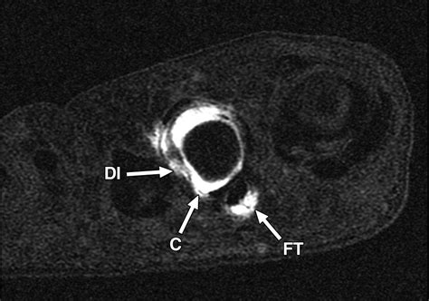 Mr Arthrography Of The Second And Third Metatarsophalangeal Joints For