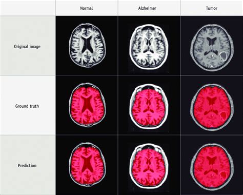 Results Of The Brain Extraction Model For Different Diseases