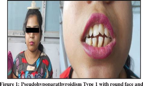 Pseudohypoparathyroidism Face