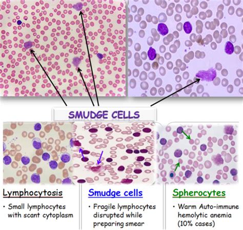 Chronic Leukemia Flashcards Quizlet