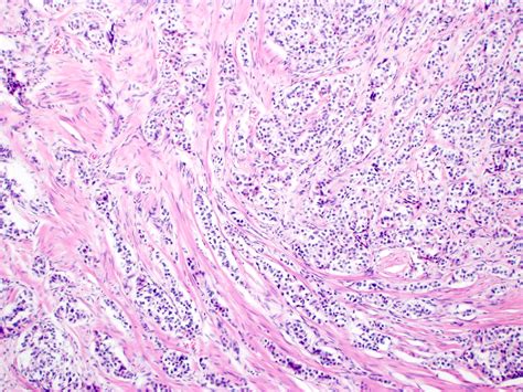 Pathology Outlines Neuroendocrine Tumor