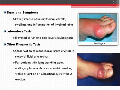 Gout And Hyperuricemia
