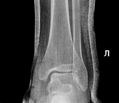 Перелом лодыжки без смещения. Снимать ли гипс через 4 недели? - Вопрос ...
