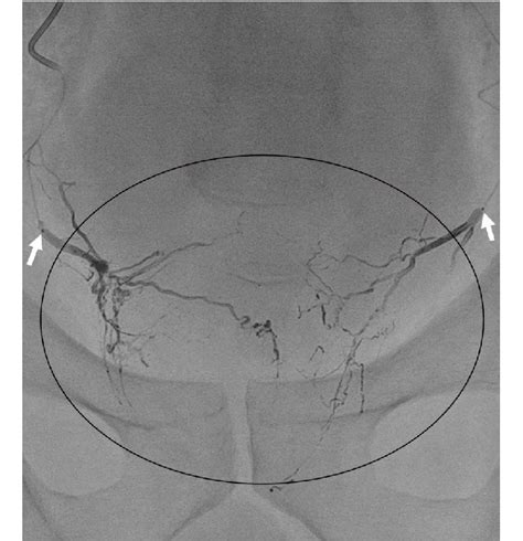 Pelvic Ap View After Embolization Legend In The Black Circle