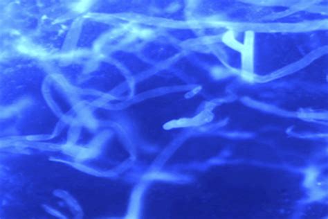 Case Series Mixed Infectious Keratitis By Pythium Insidiosu