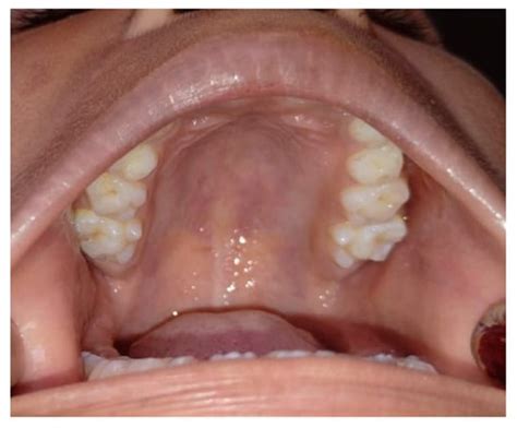 Bilateral Tuberculum Sextum Of Maxillary Permanent First Molar